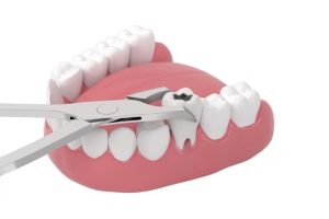 Impact of Tooth Extraction on Bite and Jaw Health